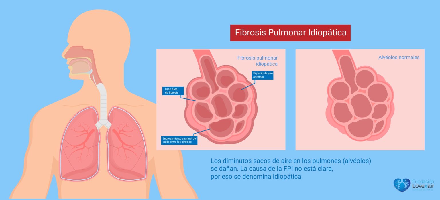 ¿Cómo abordar la fibrosis pulmonar idiopática en tiempos de COVID-19 ...
